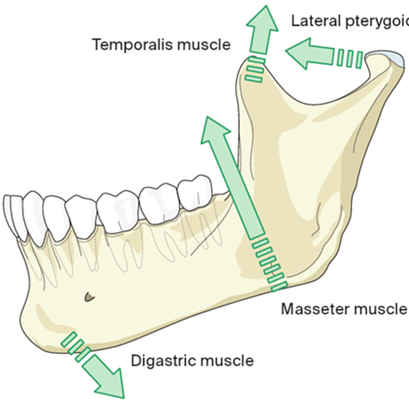 “What Muscle Pull Vectors Affect Displacement of Mandible Fractures ...
