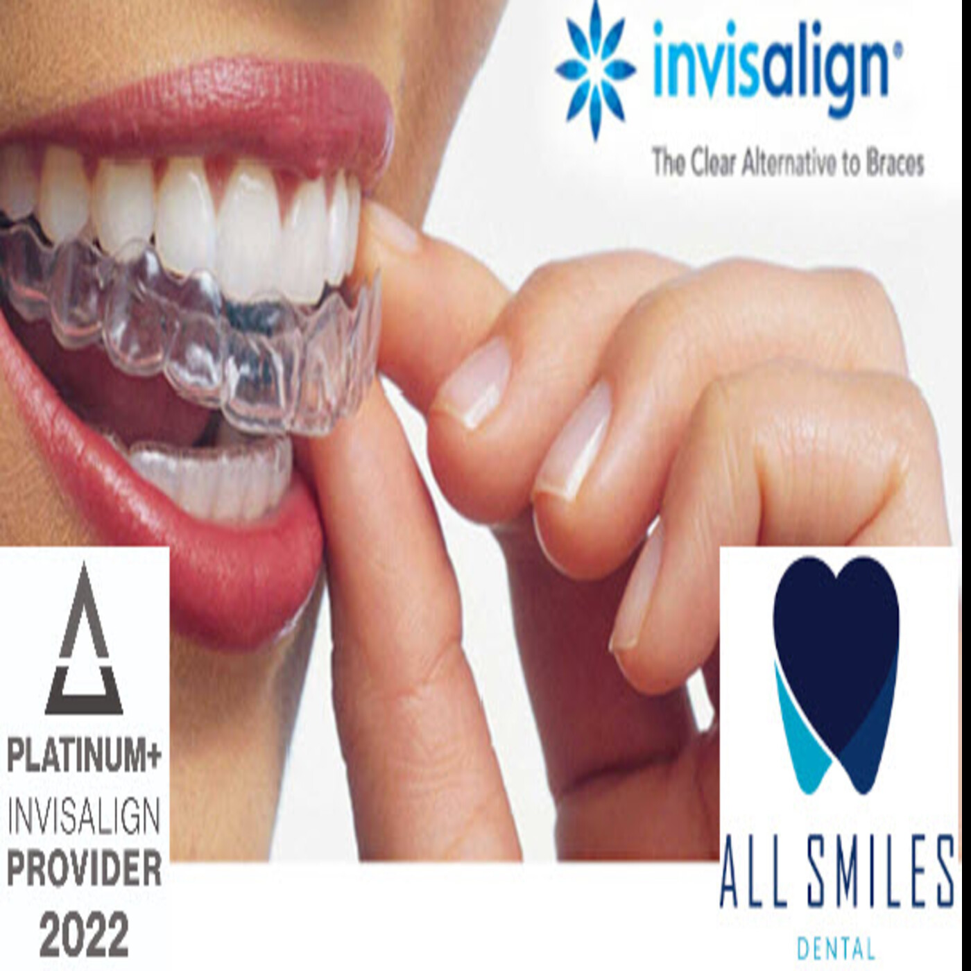 Epsom Auckland - Dental Practice Offers Removable Invisalign Braces For Teens - UBC News World ...