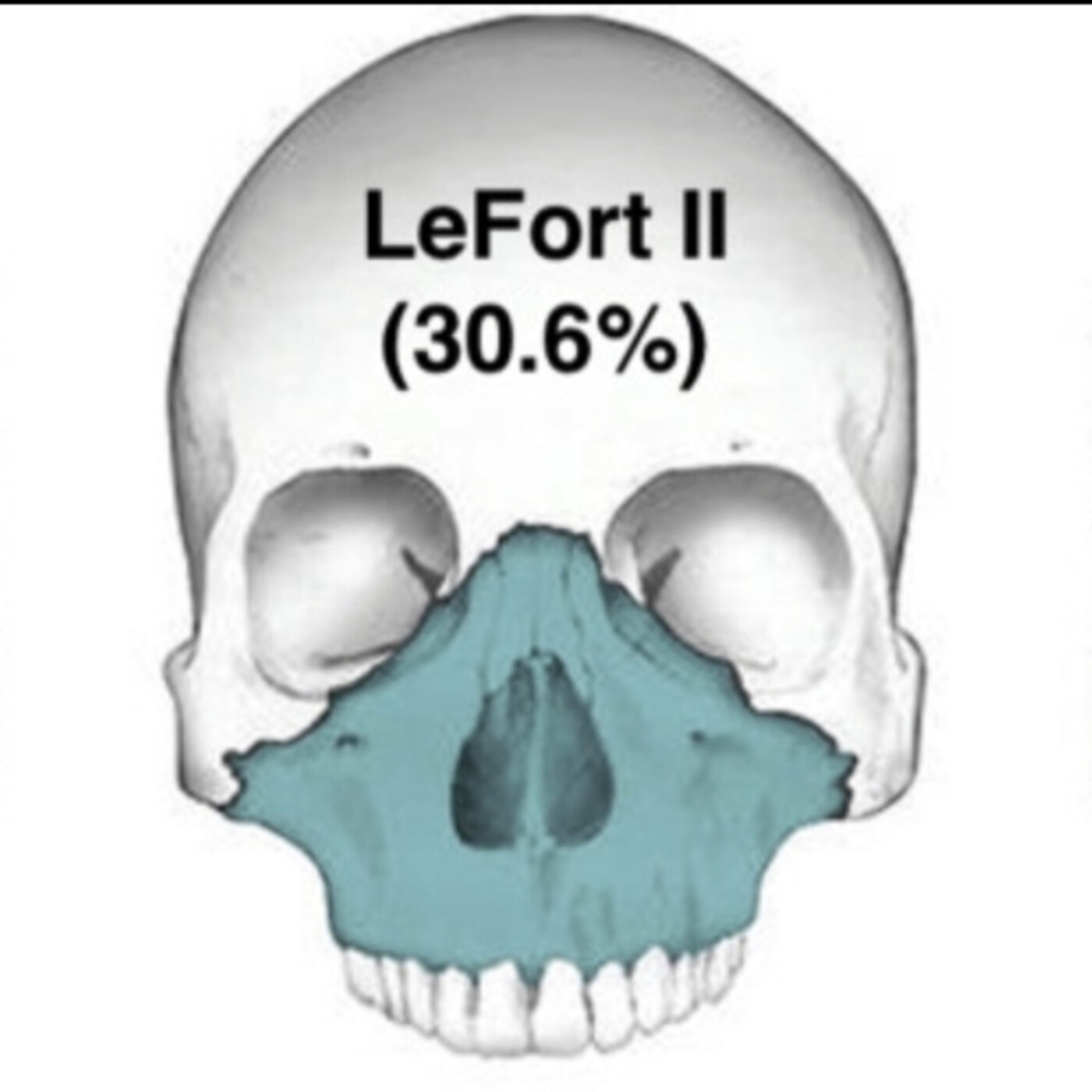 “What are the 3 LeFort Fracture Types?” - Dr. Gallagher's Podcast ...